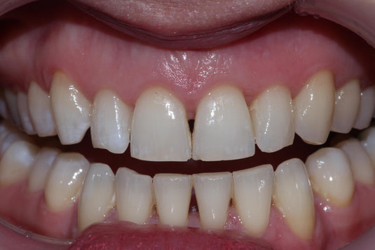 Upper and Lower Black Triangle Closure Following Periodontal Disease ...