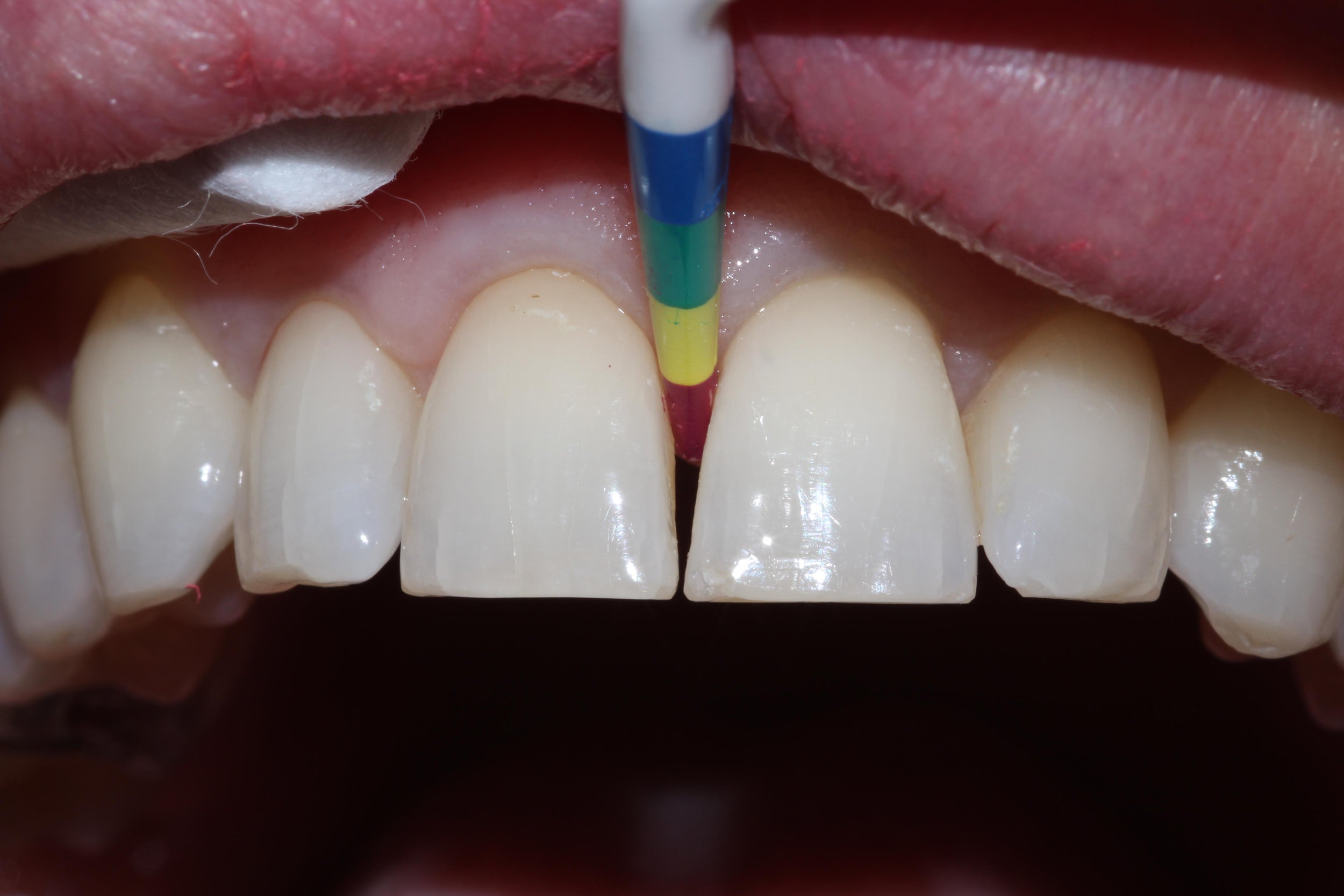 Upper and Lower Black Triangle Closure Following Periodontal Disease ...