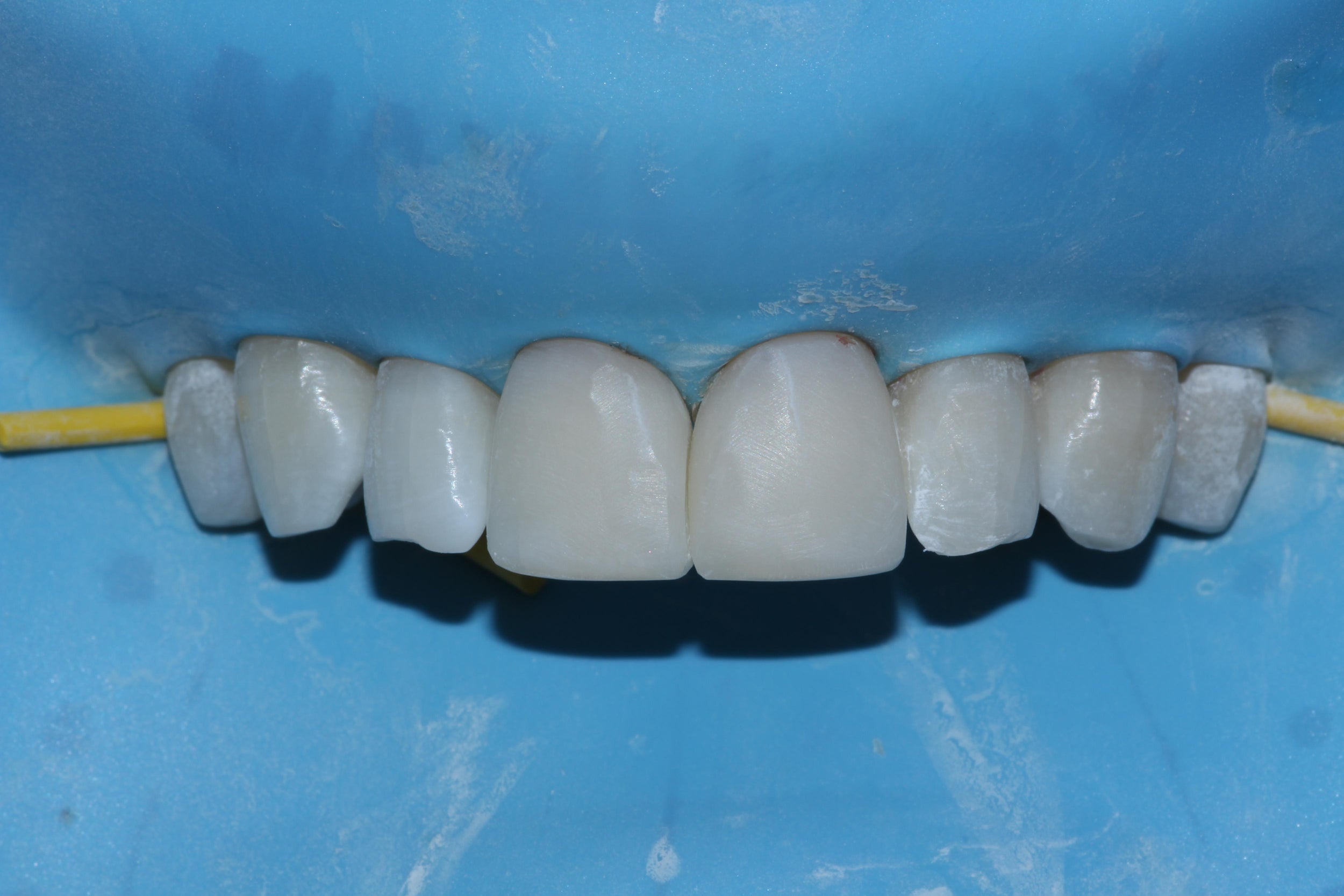 Upper and Lower Black Triangle Closure Following Periodontal Disease ...