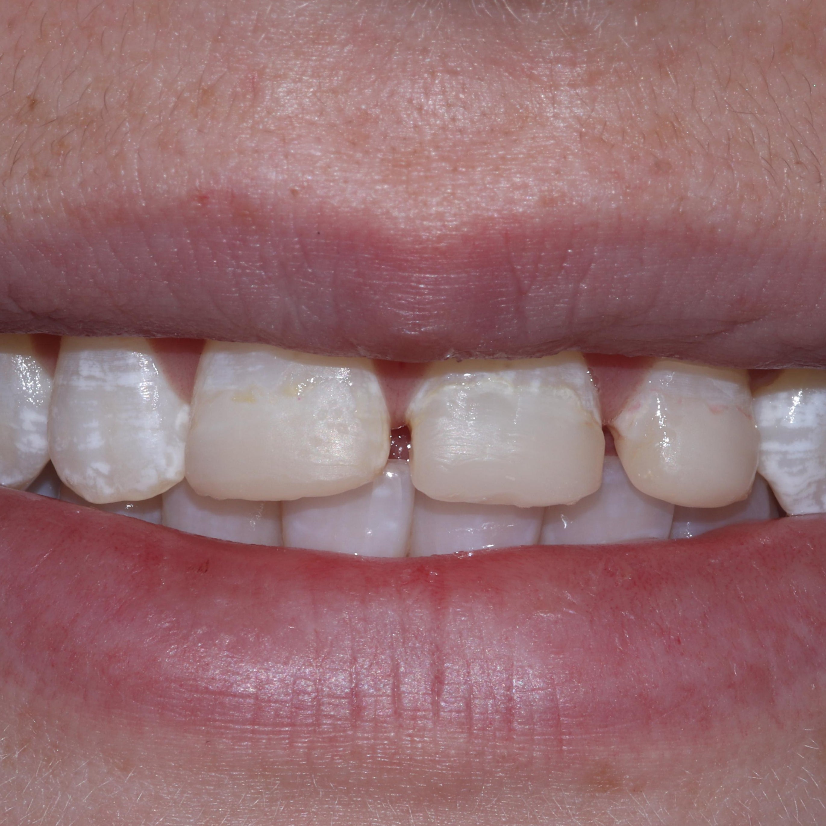 composite-courses – Bioclear UK