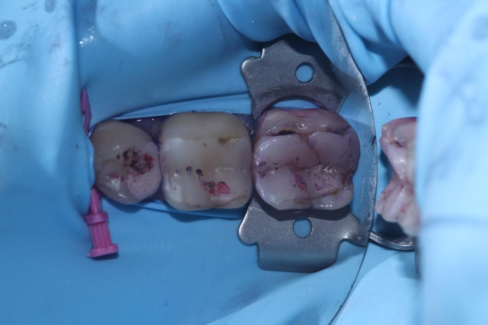 Bioclear Complete Posterior Composite Course – www.bioclearmatrix.co.uk